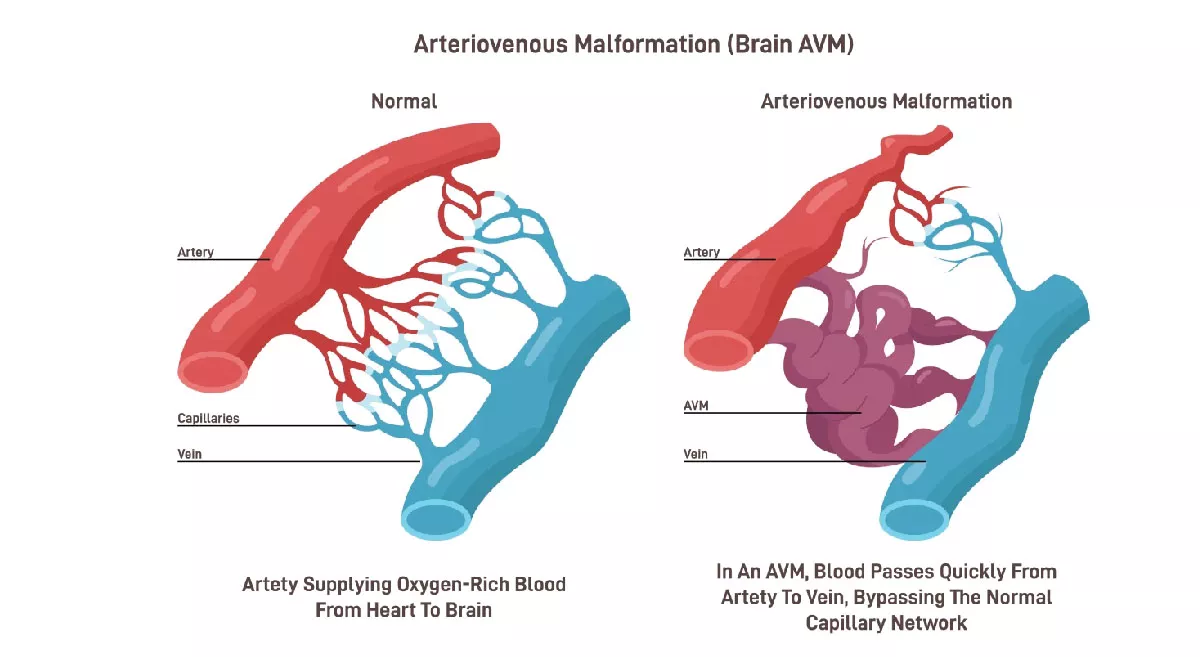 Understanding Brain AVM: Symptoms, Risks & Treatments | Aster RV